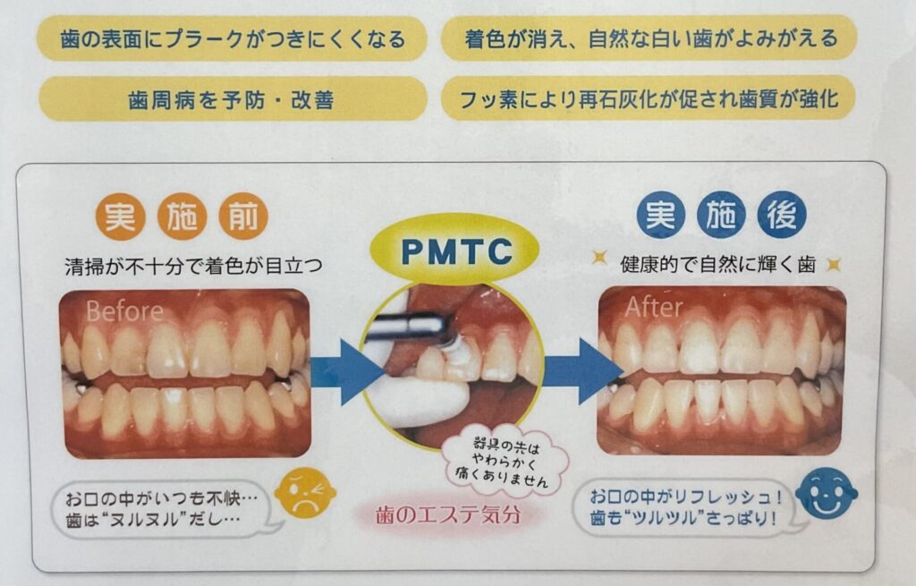 PMTCで白く、ツルツルの歯に♫ ｜ 東海市の歯医者｜さくら歯科矯正歯科